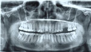 OPG Orthopantomogram: What It Is and Why It’s Important in Dentistry